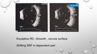Ultrasound of eye - B scan | PPTX