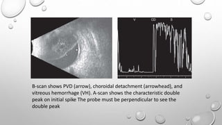 Ultrasound of eye - B scan | PPTX