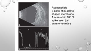 Ultrasound of eye - B scan | PPTX