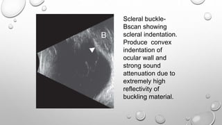 Ultrasound of eye - B scan | PPTX
