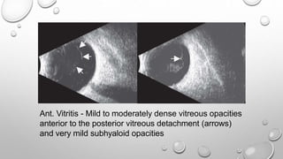 Ultrasound of eye - B scan | PPTX