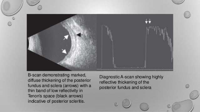 Ultrasound of eye - B scan
