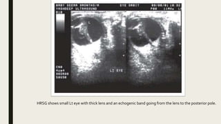 B scan clinical cases 1 | PPTX