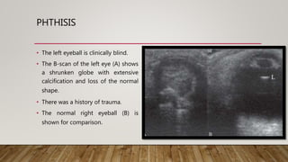 B scan clinical cases 2 | PPT