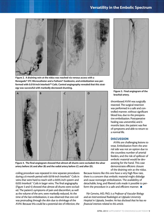 ENDOVASCULAR TODAY - BOSTON SCIENTIFIC | PDF