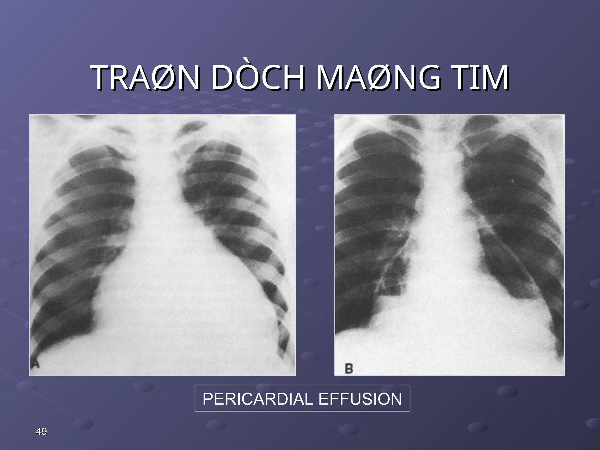 Bs Khoang - chan doan hinh anh tim mach | PPT