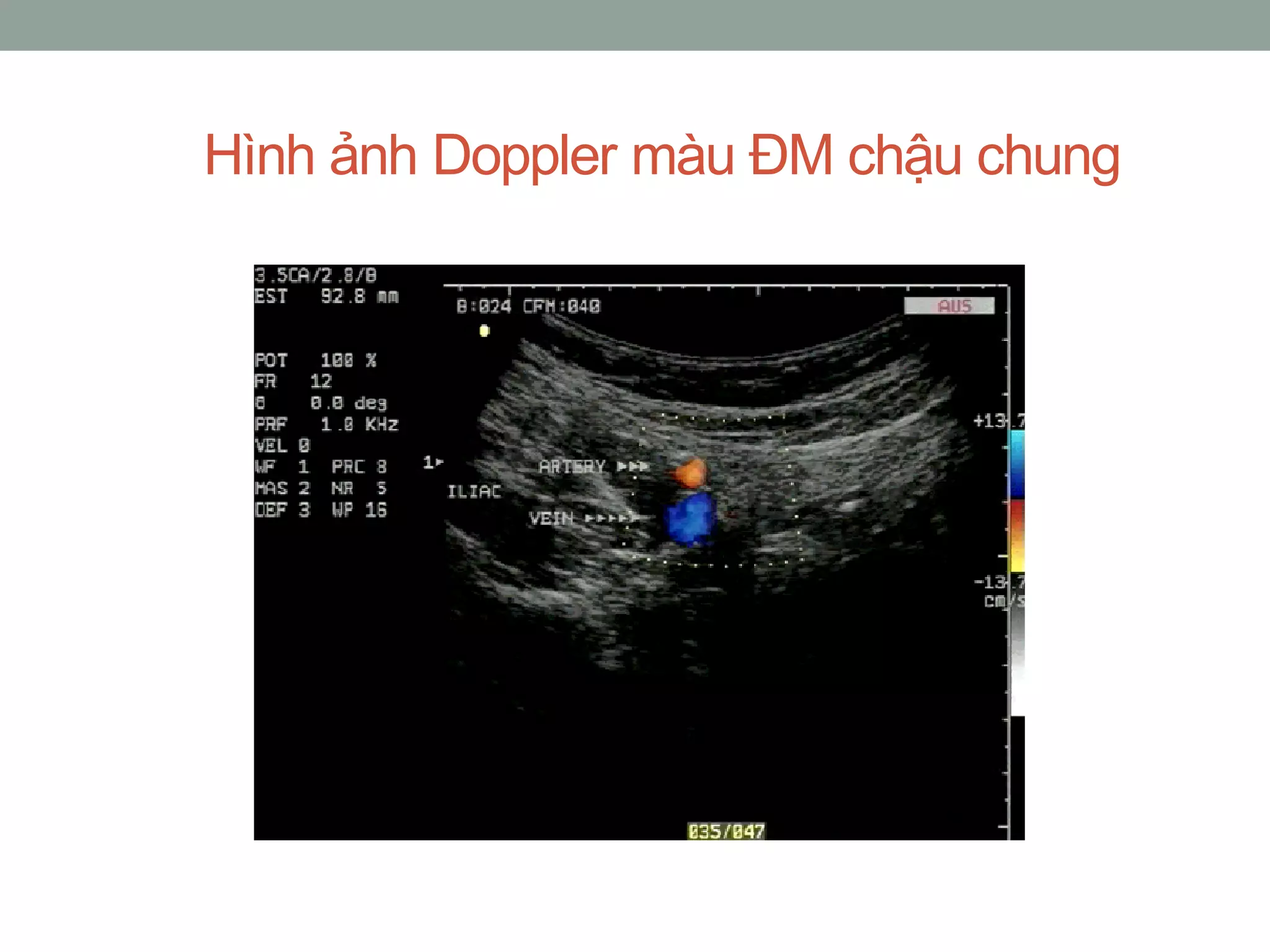 sieu am mach mau chi duoi | PDF