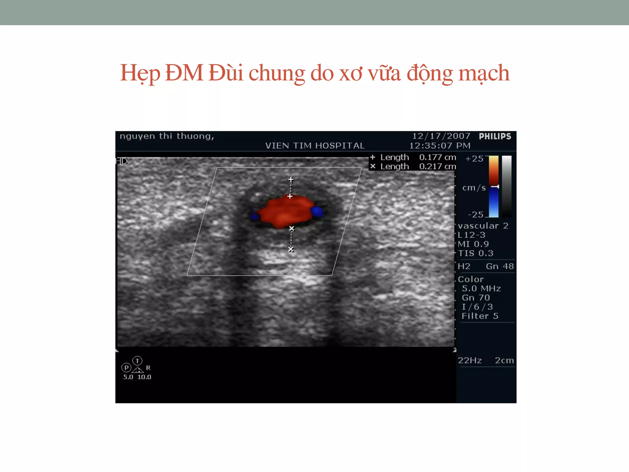 sieu am mach mau chi duoi | PDF