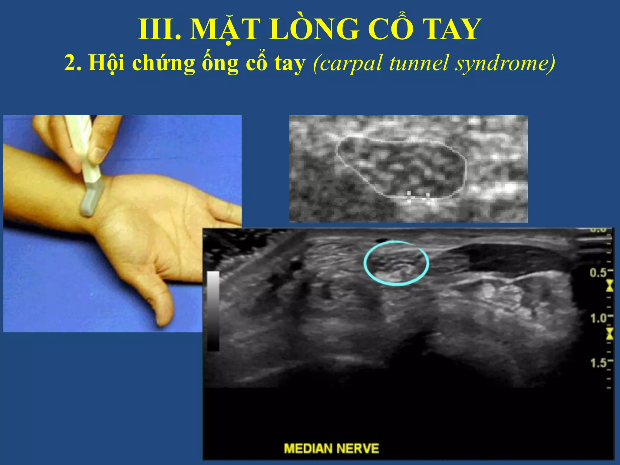 Siêu âm khớp cổ tay, Bs Lê Thanh Liêm | PDF