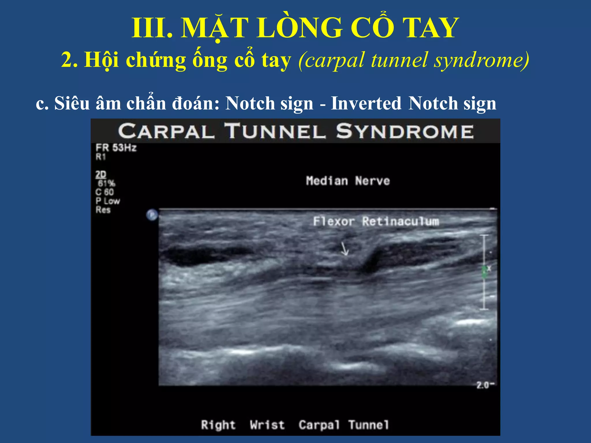 Siêu âm khớp cổ tay, Bs Lê Thanh Liêm | PDF