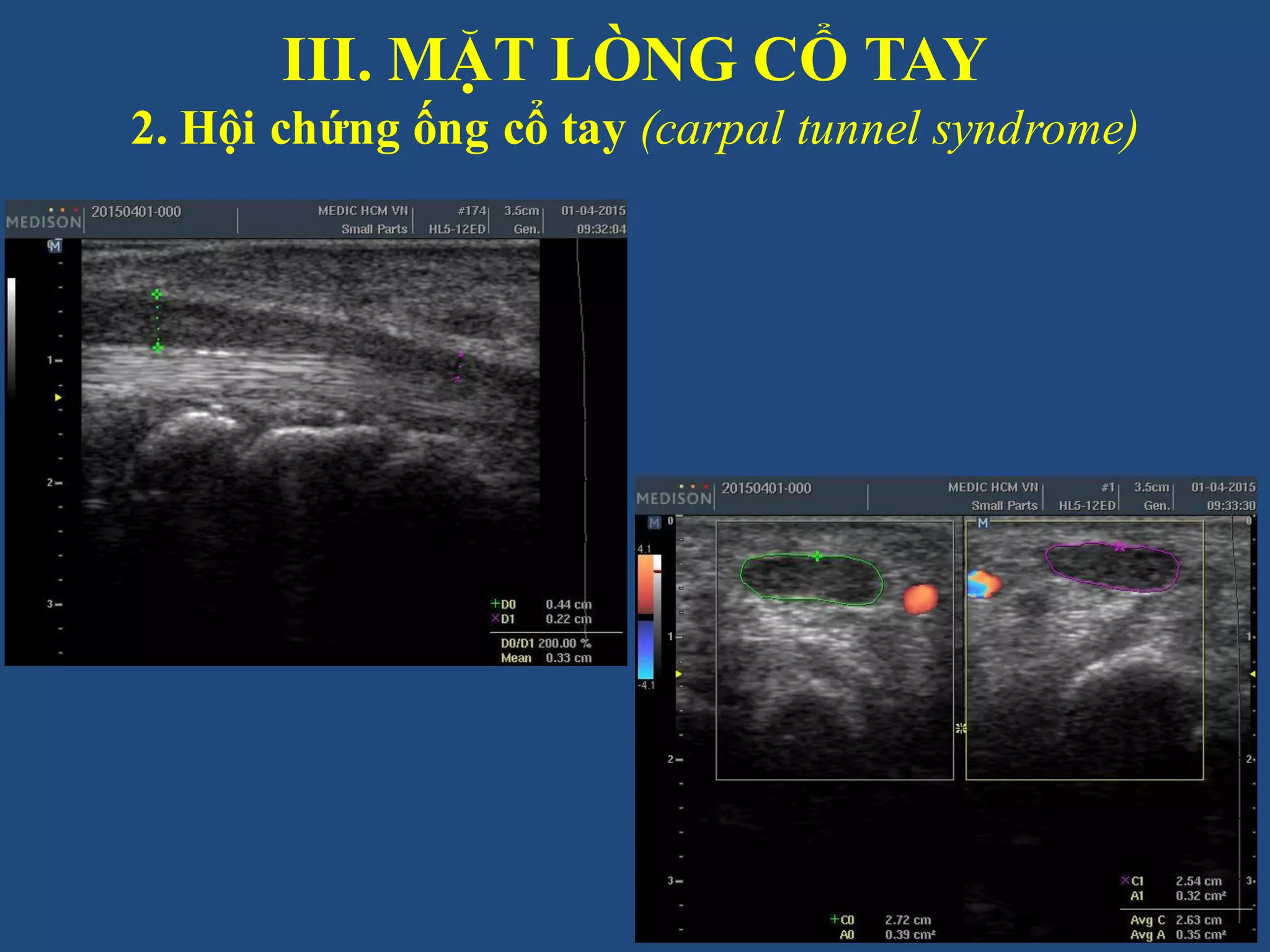Siêu âm khớp cổ tay, Bs Lê Thanh Liêm | PDF