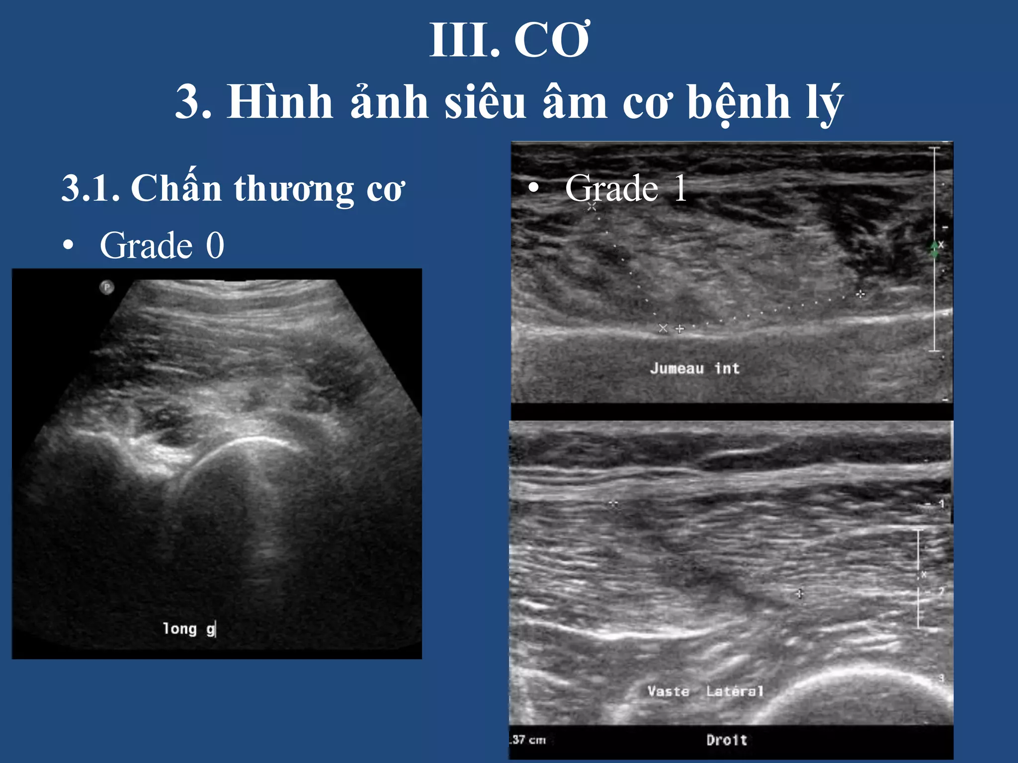 Tổng quan siêu âm cơ xương khớp, Bs Liêm | PDF