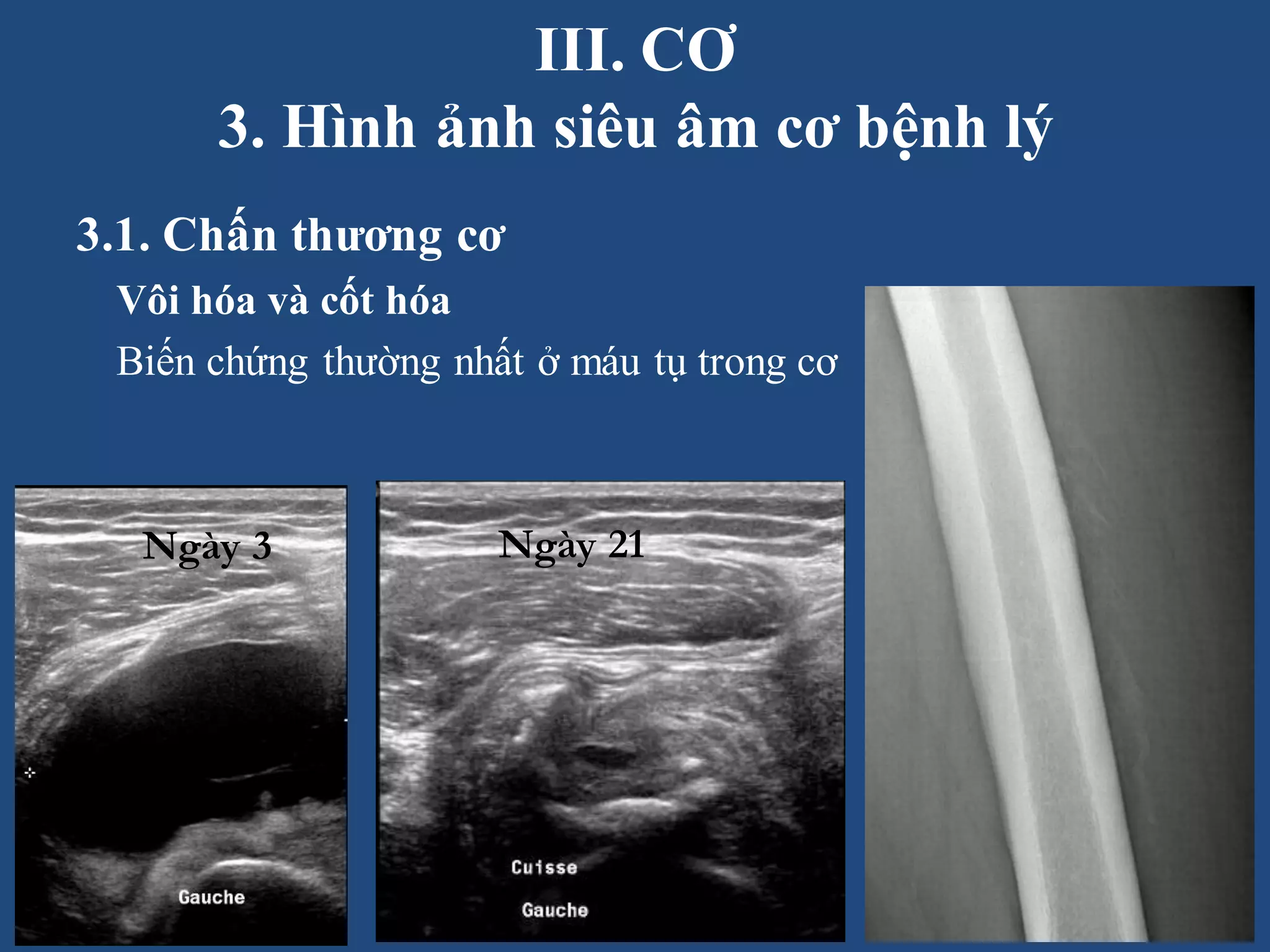 Tổng quan siêu âm cơ xương khớp, Bs Liêm | PDF