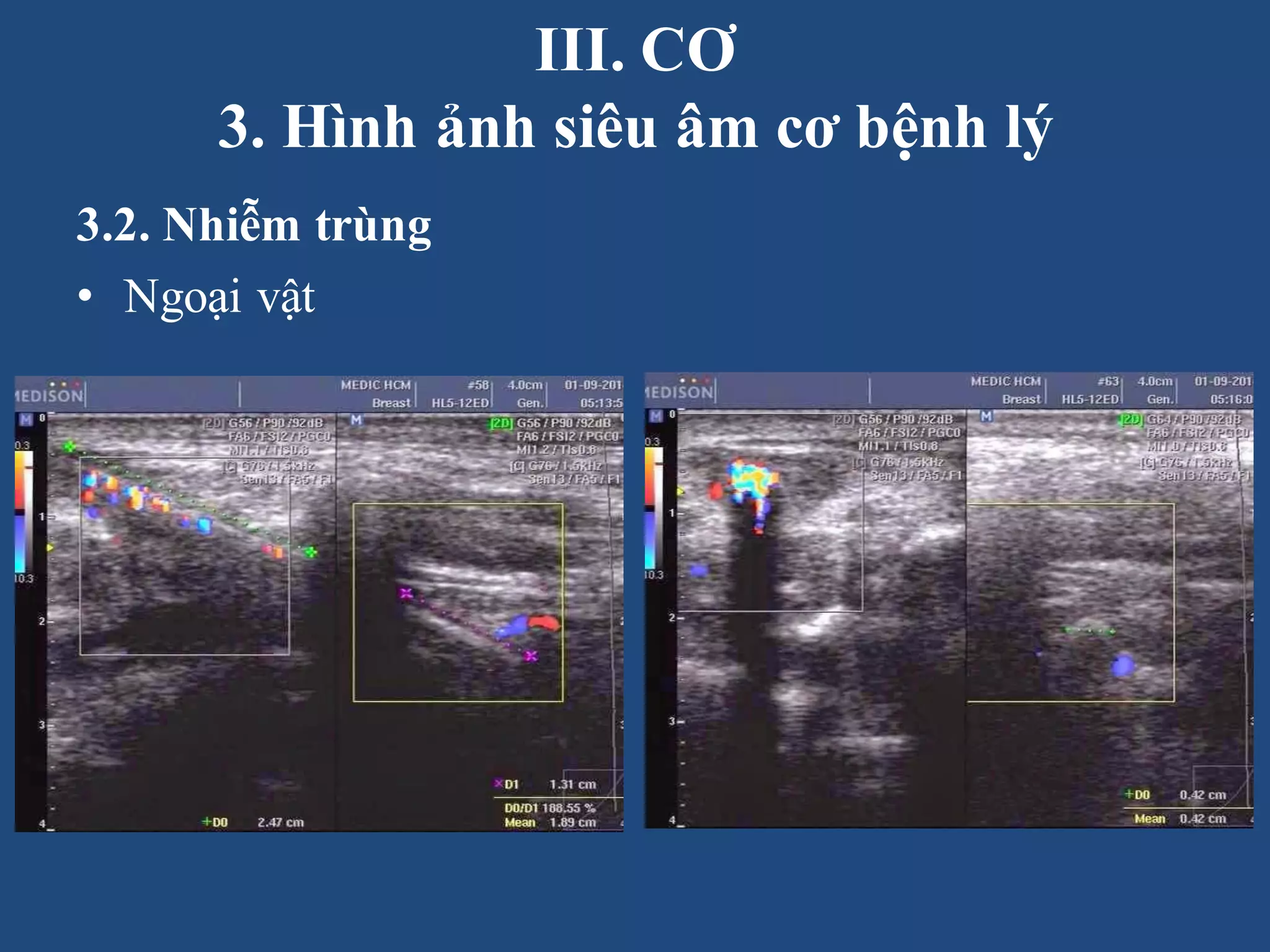 Tổng quan siêu âm cơ xương khớp, Bs Liêm | PDF