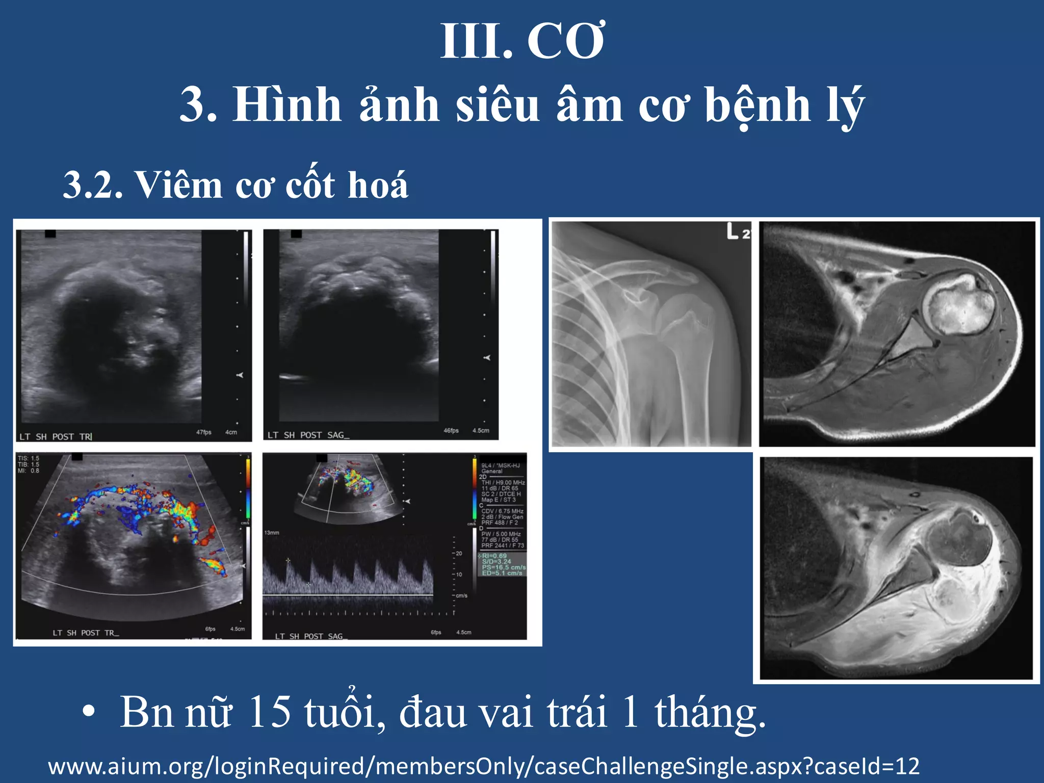 Tổng quan siêu âm cơ xương khớp, Bs Liêm | PDF