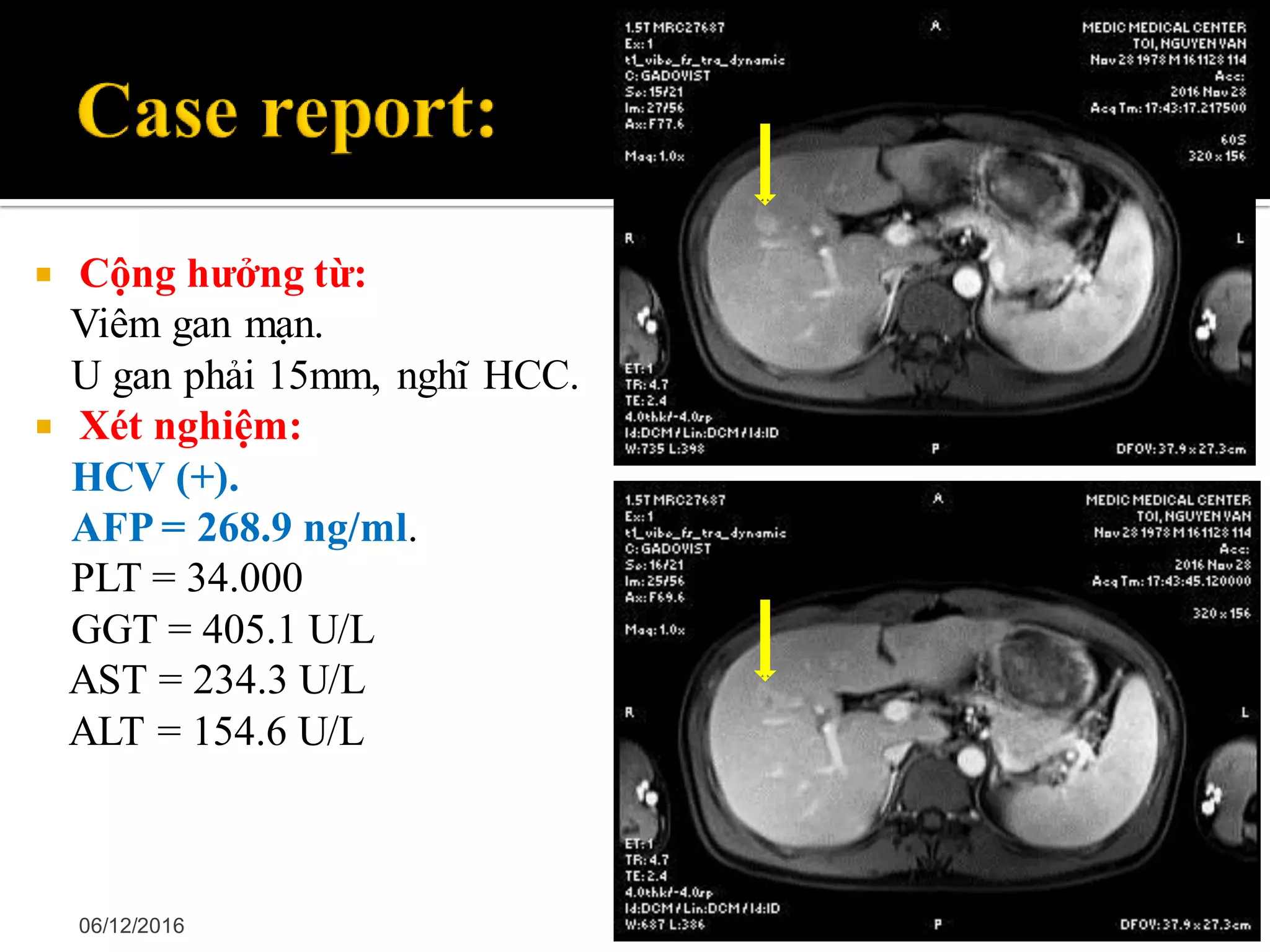 Tổng quan siêu âm đàn hồi và ứng dụng trong cơ xương khớp, Bs Liêm | PDF