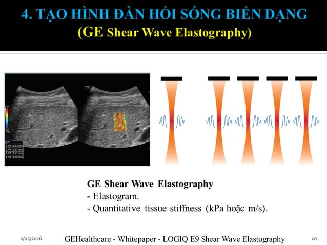 Tổng quan siêu âm đàn hồi và ứng dụng trong cơ xương khớp, Bs Liêm | PDF
