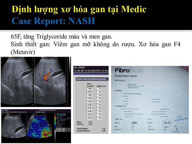 Tổng quan siêu âm đàn hồi và ứng dụng trong cơ xương khớp, Bs Liêm | PDF