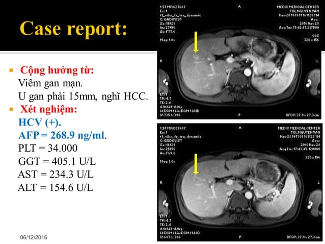 Tổng quan siêu âm đàn hồi và ứng dụng trong cơ xương khớp, Bs Liêm | PDF
