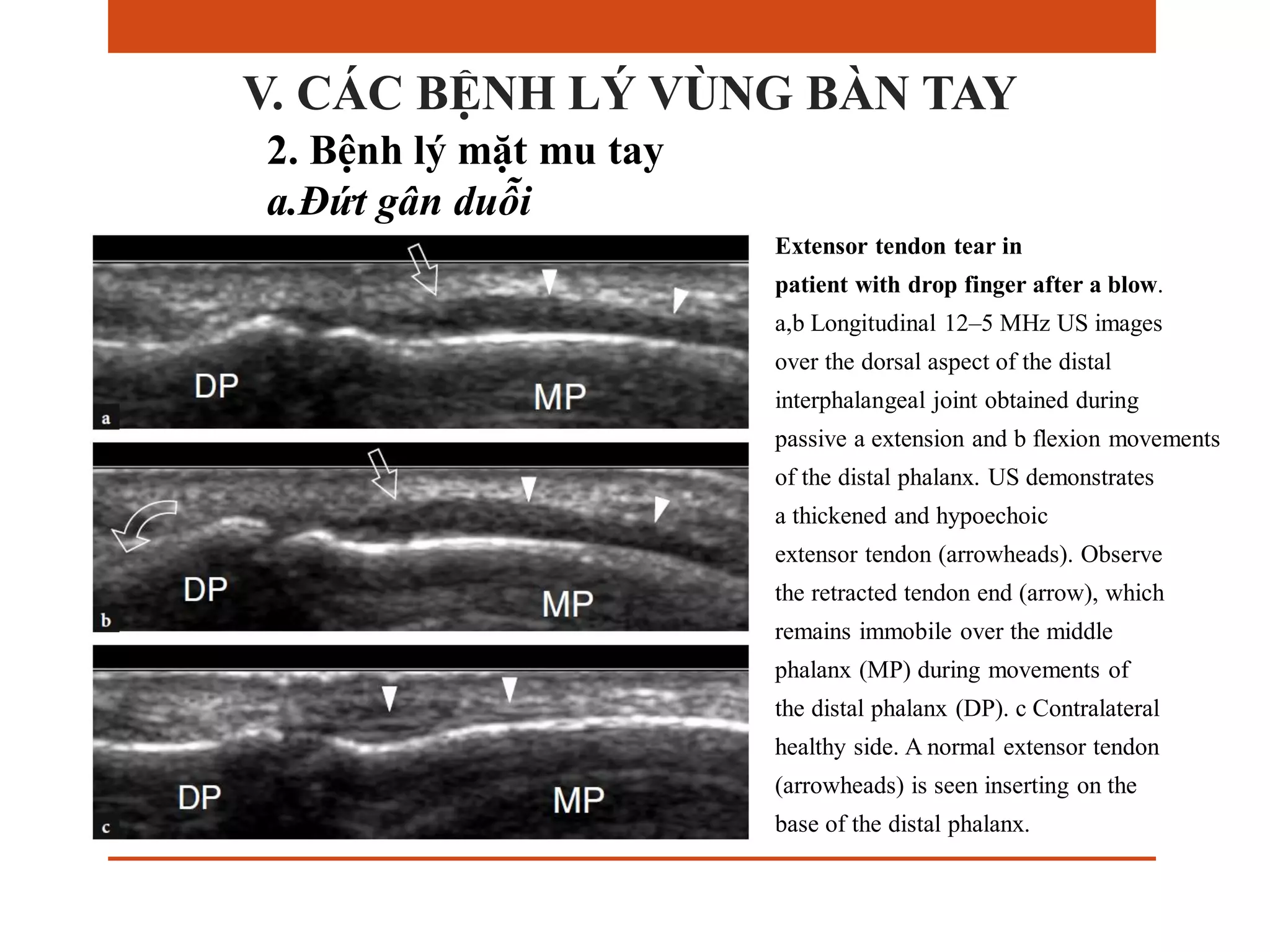 Siêu âm bàn tay, Bs Phúc | PDF