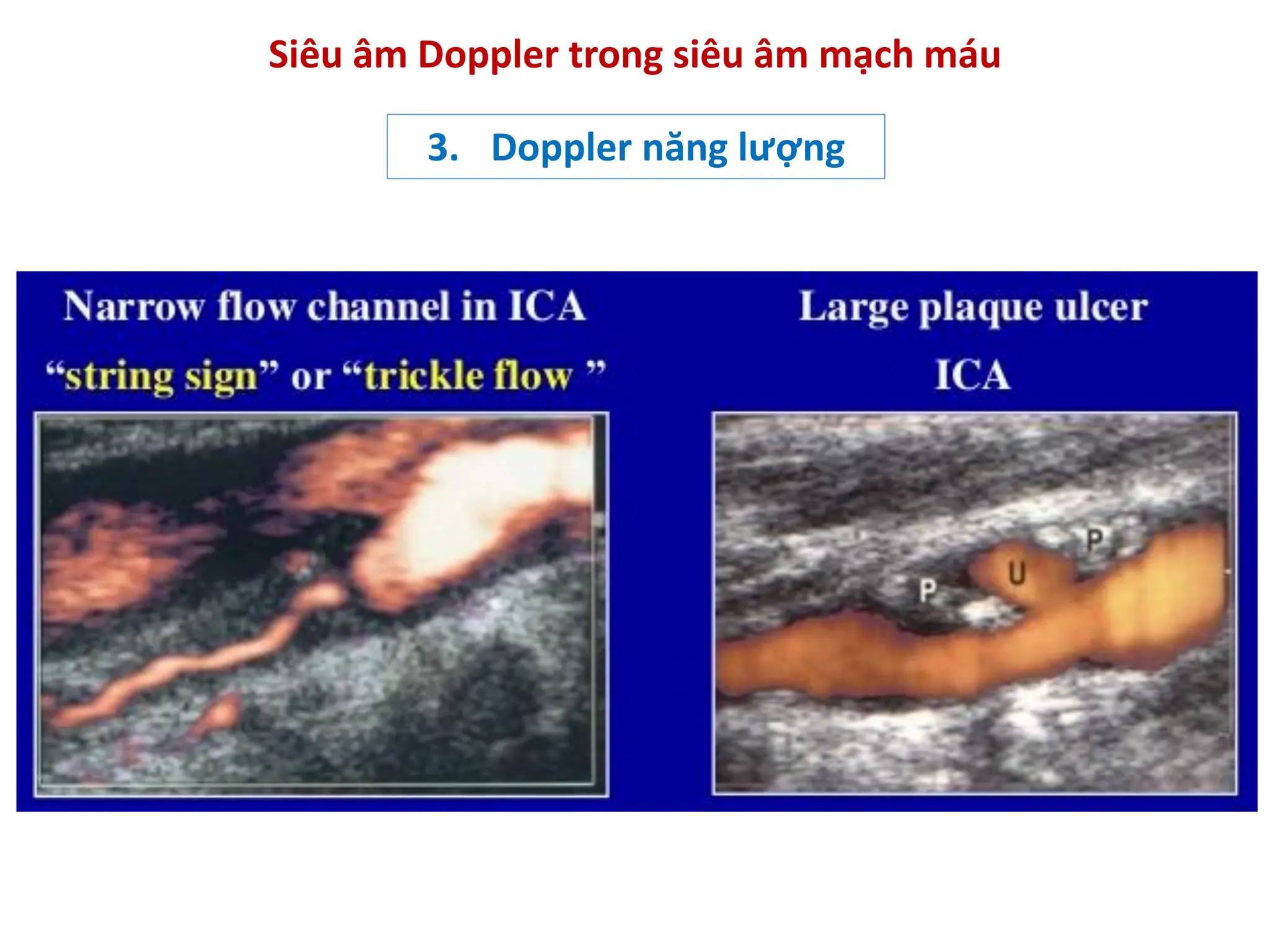 Bs Phuong - Nguyen ly co ban sieu am Doppler mach mau.pdf
