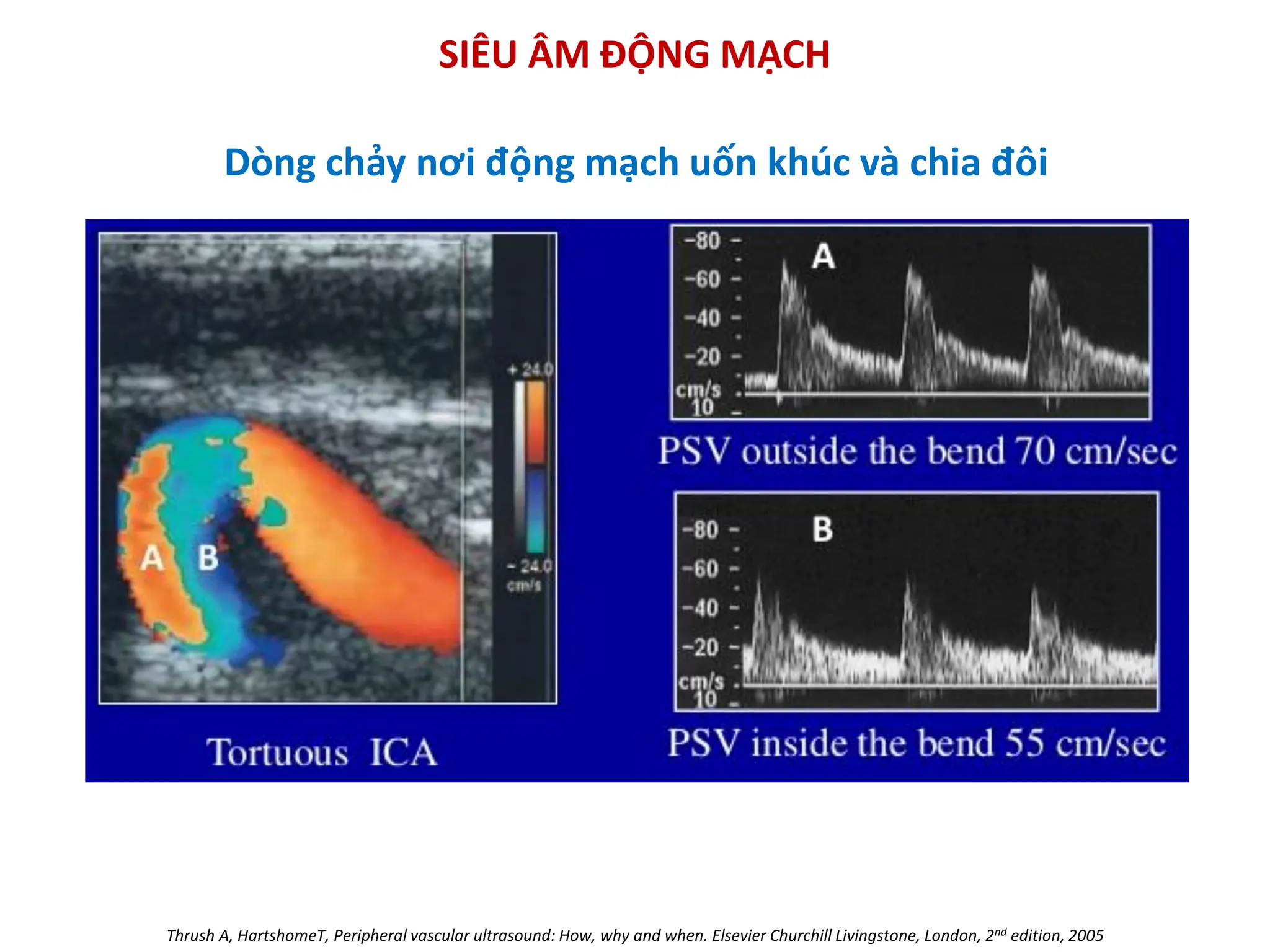 Bs Phuong - Nguyen ly co ban sieu am Doppler mach mau.pdf
