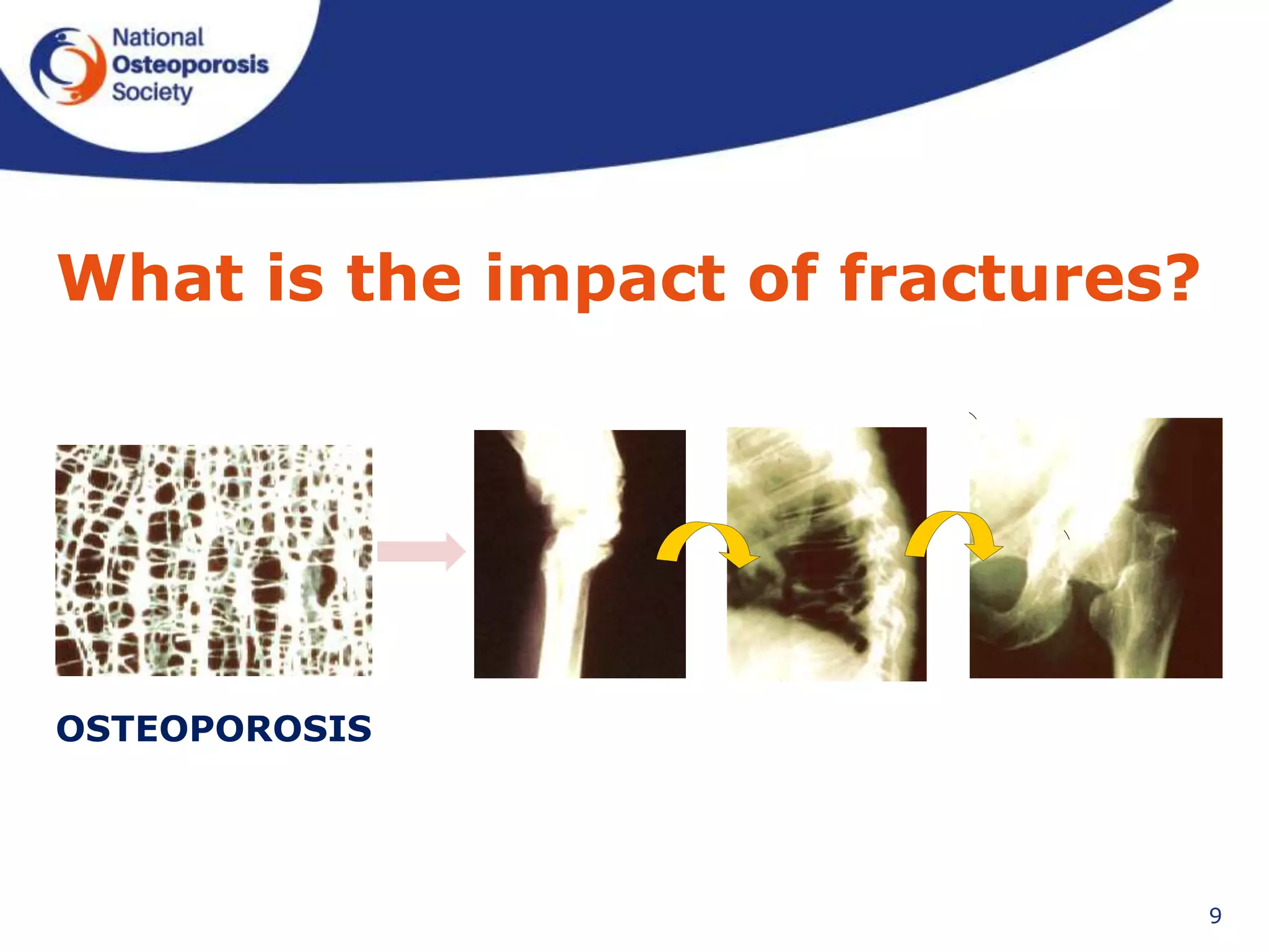 Model of support for Fracture Liaison Development and Improvement | PPTX