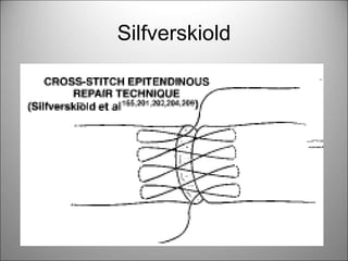 BSSH Khartoum overseas Flexor tendon repairs.ppt