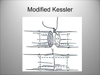 BSSH Khartoum overseas Flexor tendon repairs.ppt