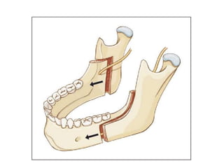 Bsso | PPTX | Dental Health | Diseases and Conditions