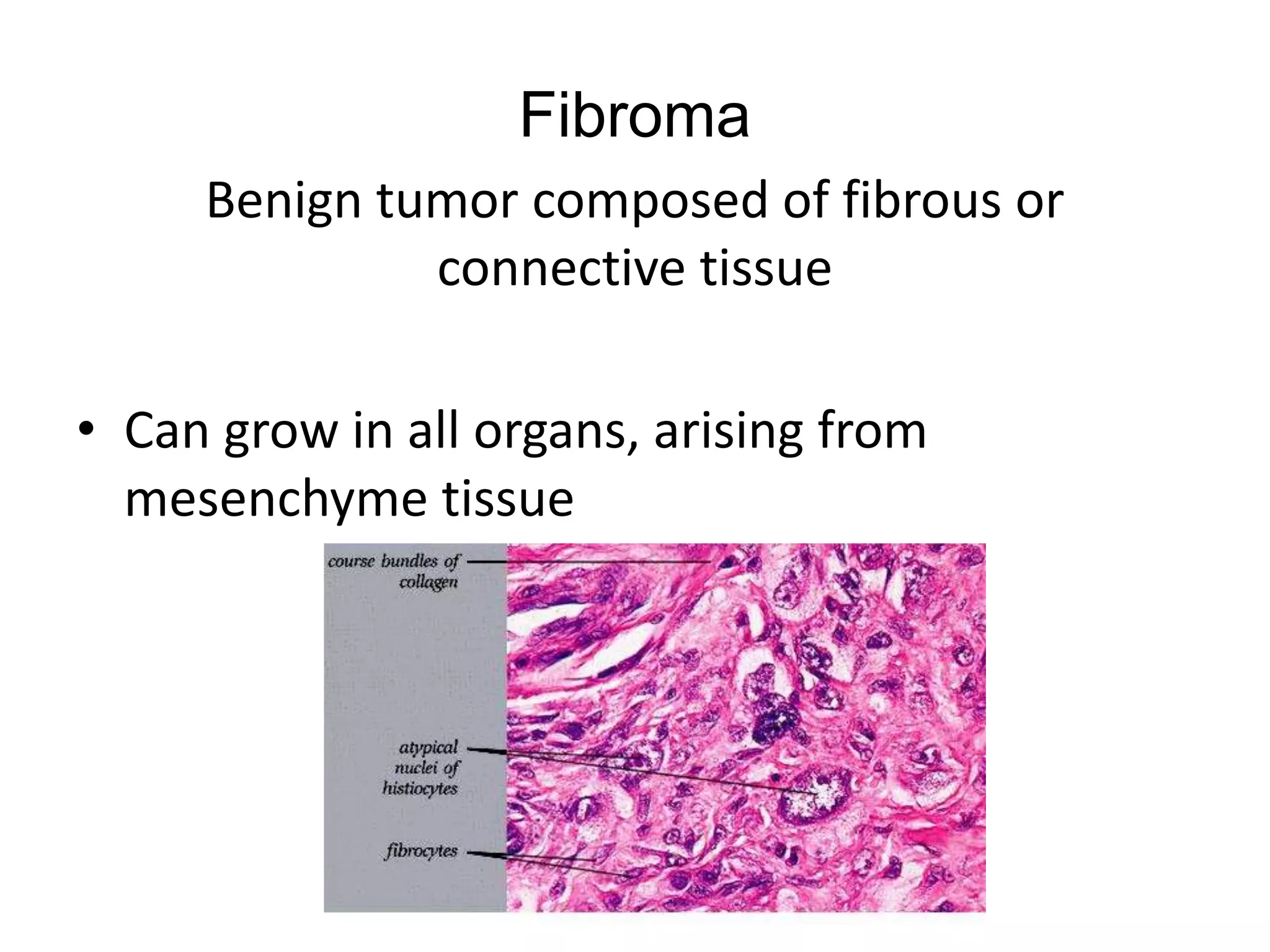 Benign Skin Tumor | PPTX