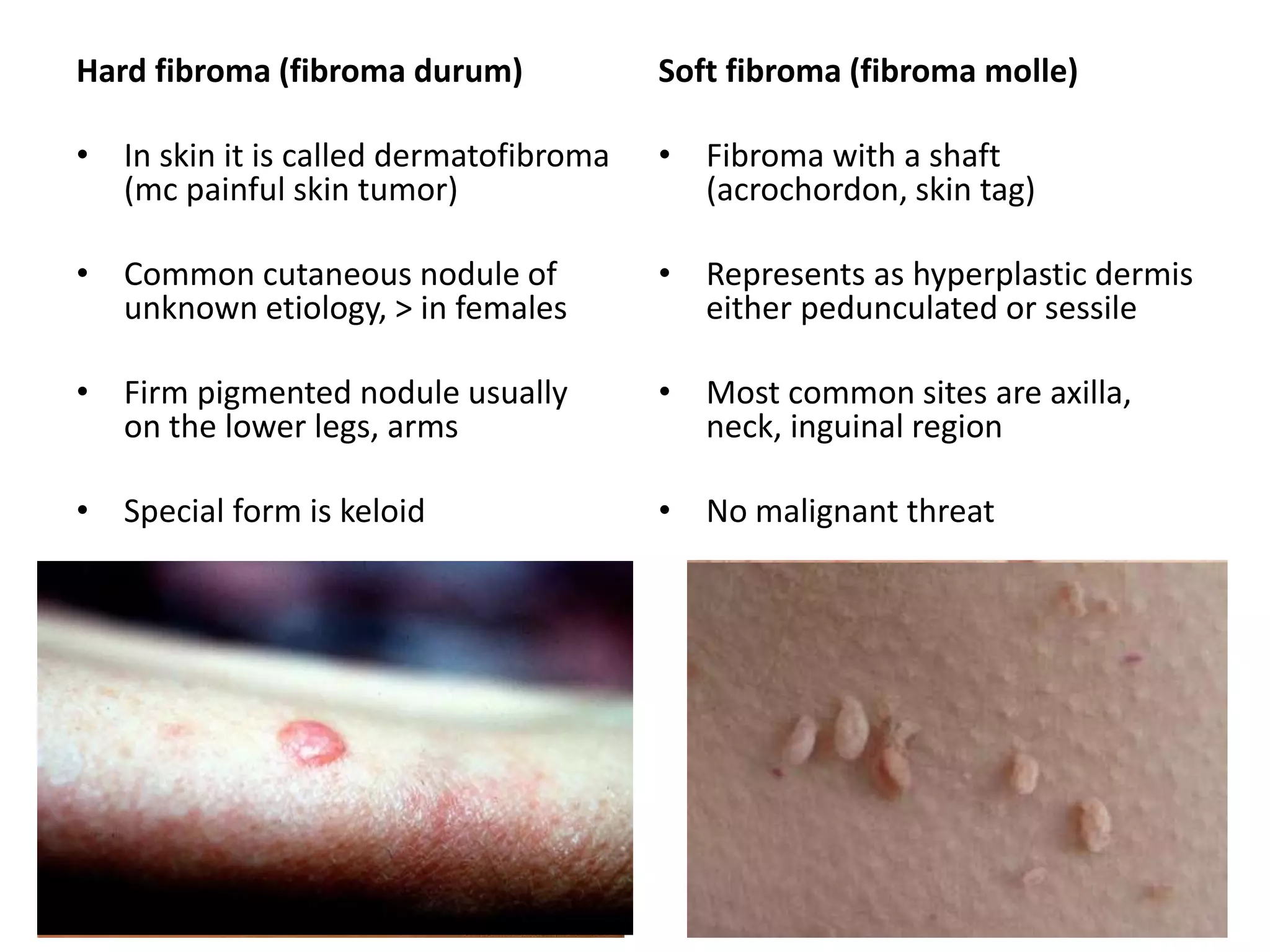 Benign Skin Tumor | PPTX
