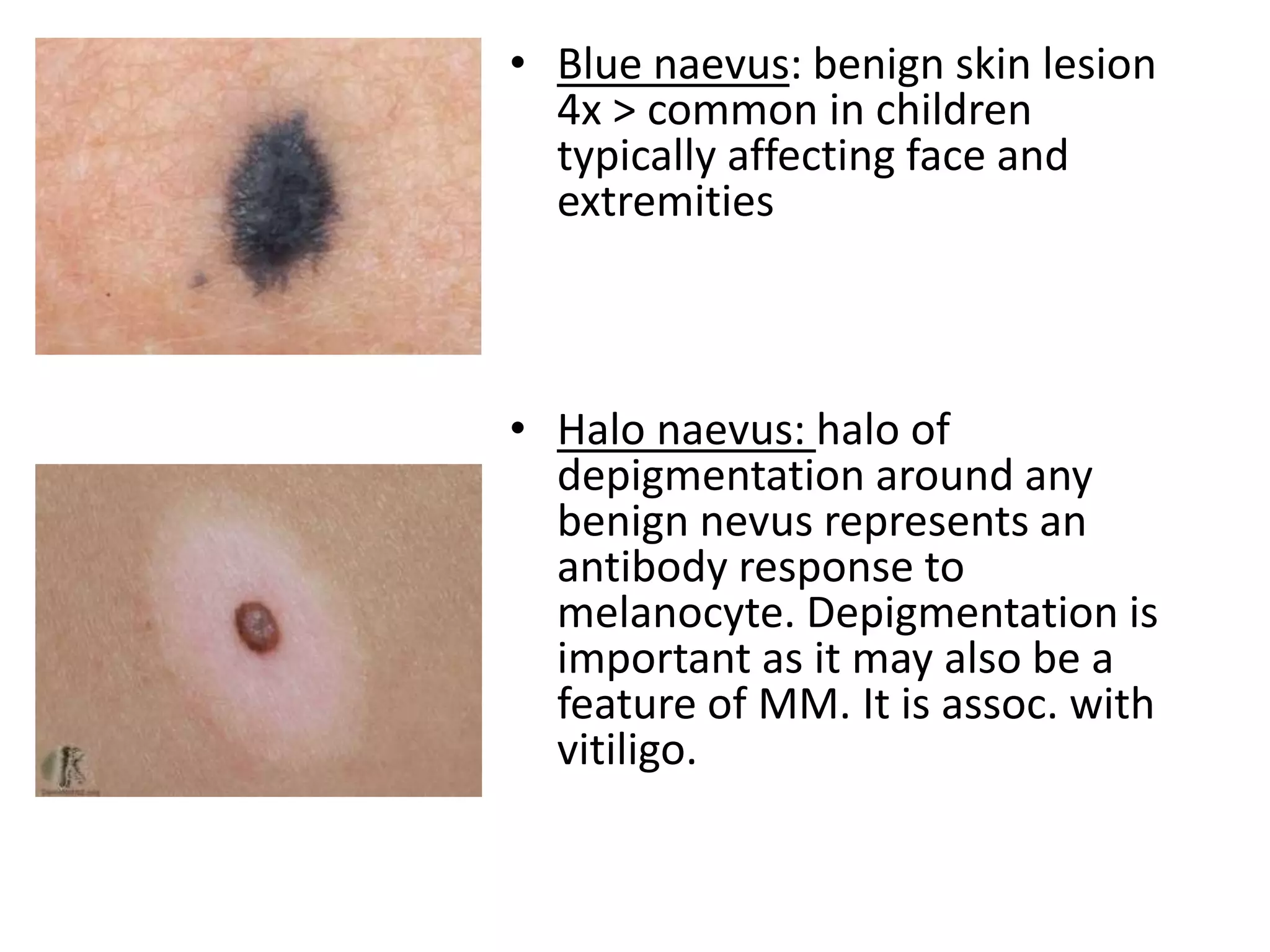 Benign Skin Tumor | PPTX