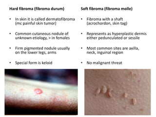 Benign Skin Tumor | PPTX