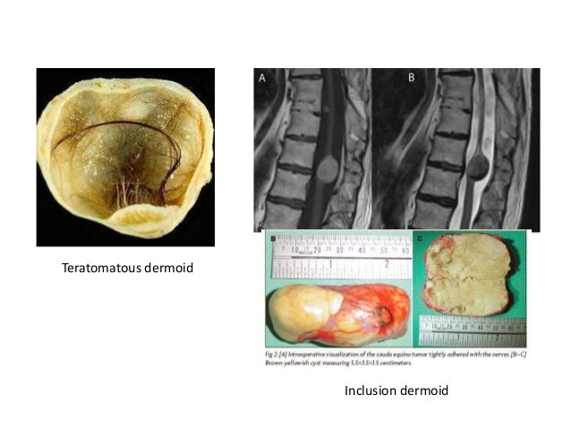 Benign Skin Tumor