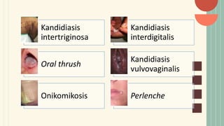 BST - Kandidiasis.pptx