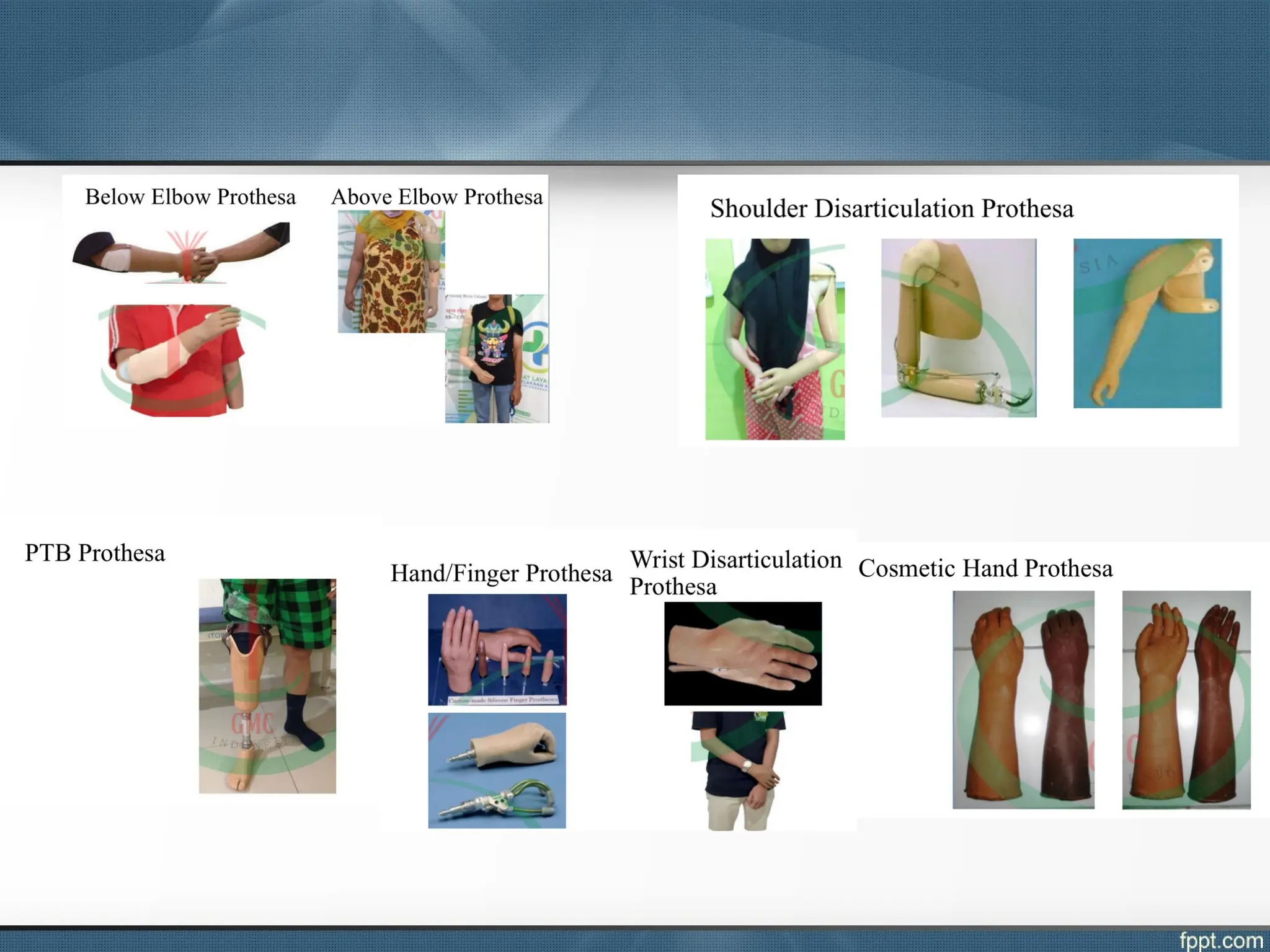 BST_Amputasi.pptxhkh ghggffttfttryhhggug | PPTX