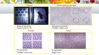 Binocular Single Vision Tests | PPTX