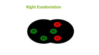 Binocular Single Vision Tests | PPTX