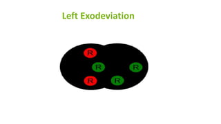 Binocular Single Vision Tests | PPTX