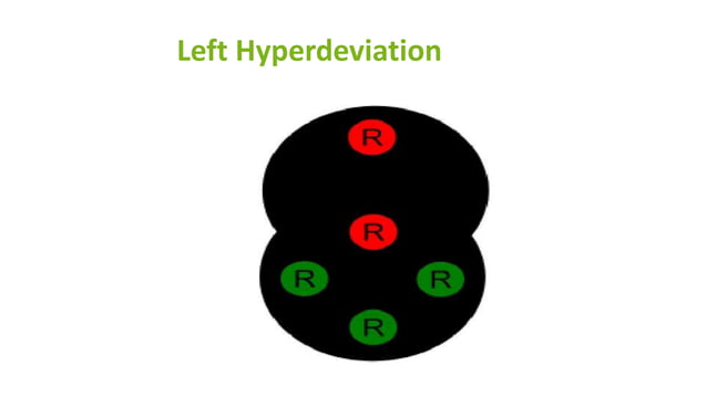 Binocular Single Vision Tests | PPTX