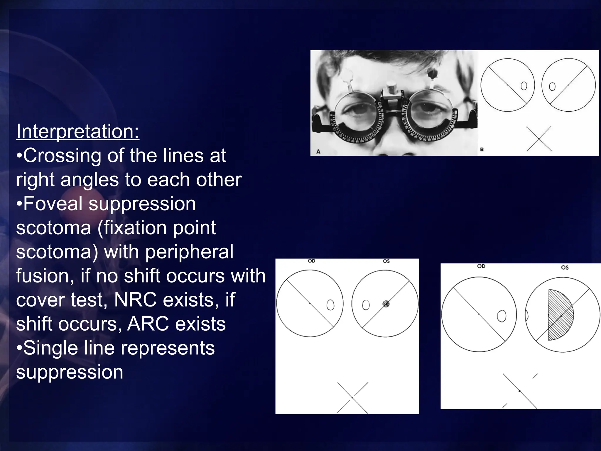 binocular single vision in humans in detail | PPTX