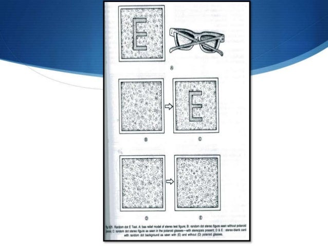 binocular single vision