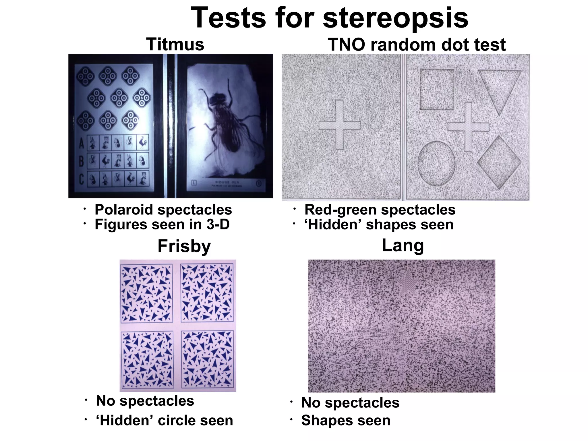 Gede Pardianto - Strabismus, binocular vision, 3D vision and visual ...