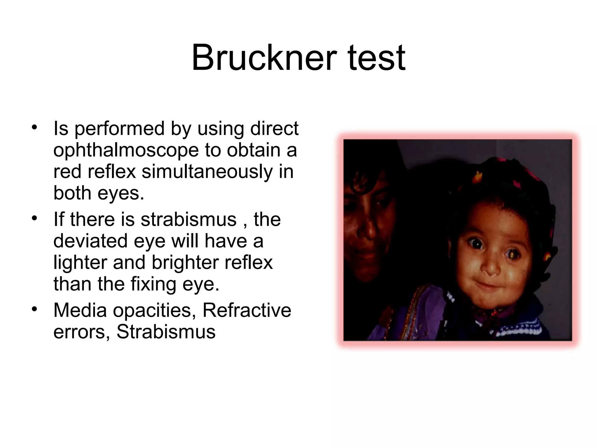 Gede Pardianto - Strabismus, binocular vision, 3D vision and visual ...