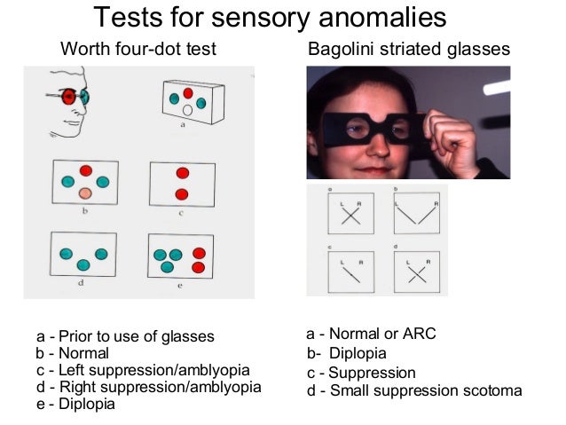 Gede Pardianto - Strabismus, binocular vision, 3D vision and visual i…