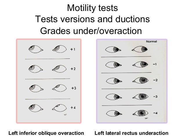 Gede Pardianto - Strabismus, binocular vision, 3D vision and visual i…