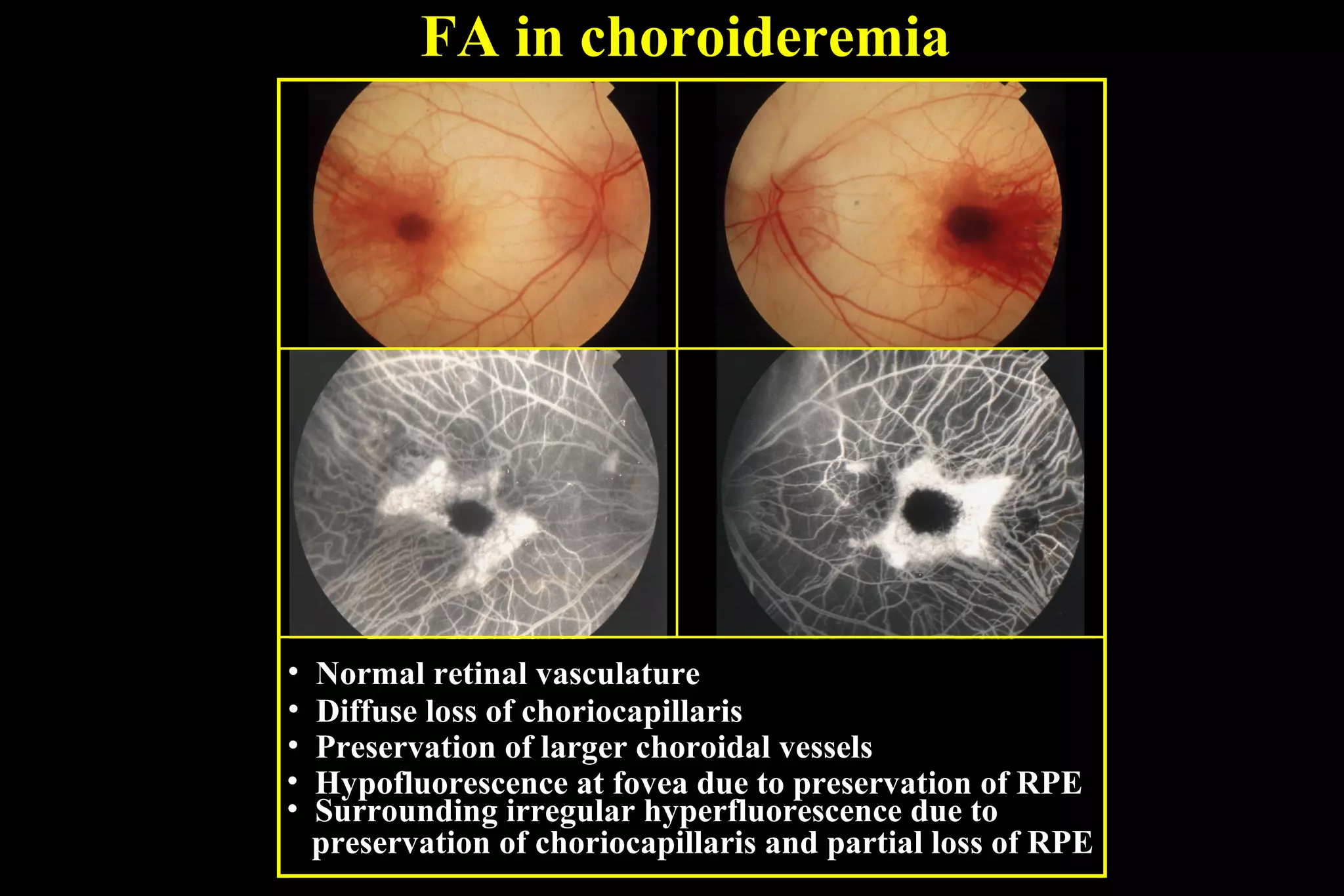 47 hereditary choroidal dystropathies | PPT