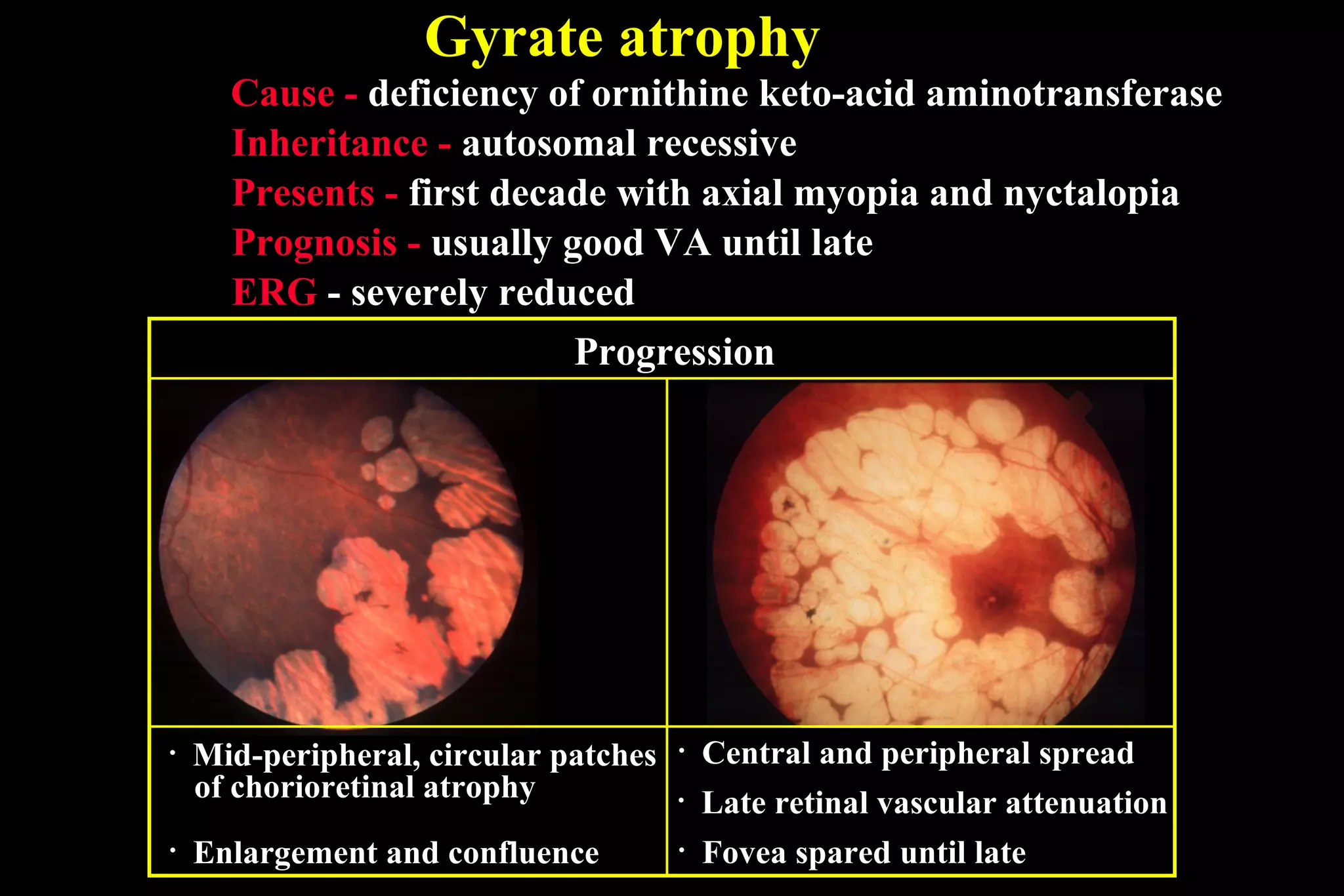 47 hereditary choroidal dystropathies | PPT