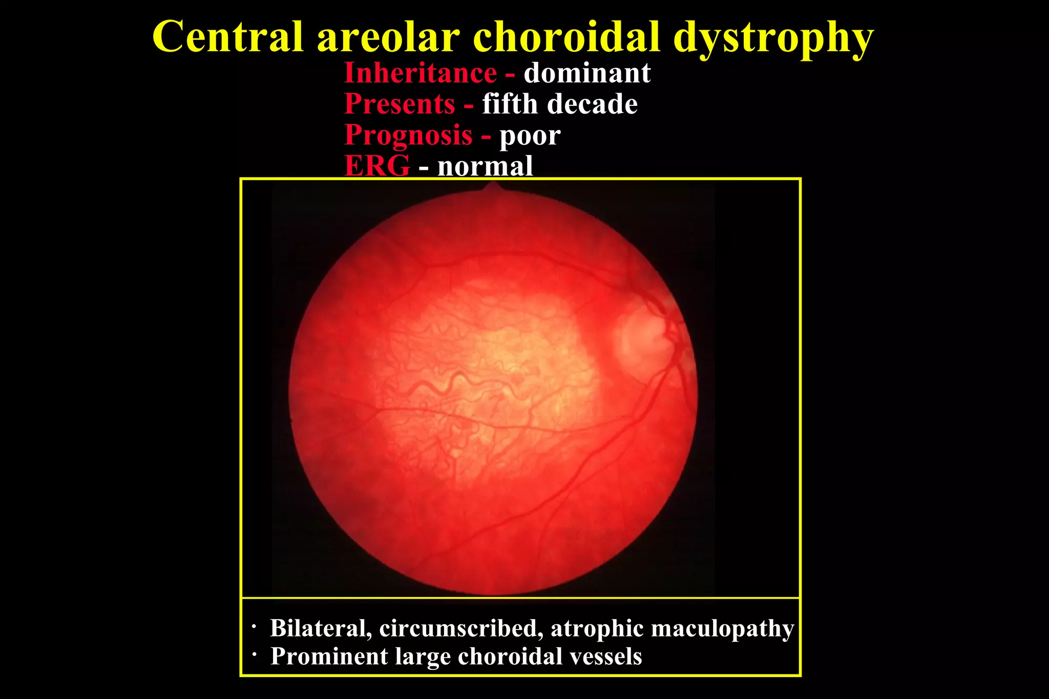 47 hereditary choroidal dystropathies | PPT